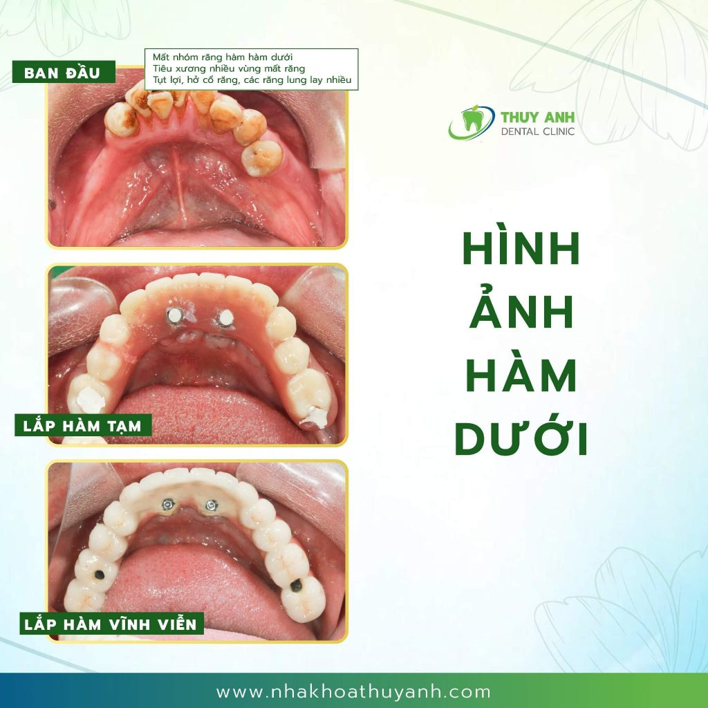 Quy trình trồng răng implant toàn hàm all on 4