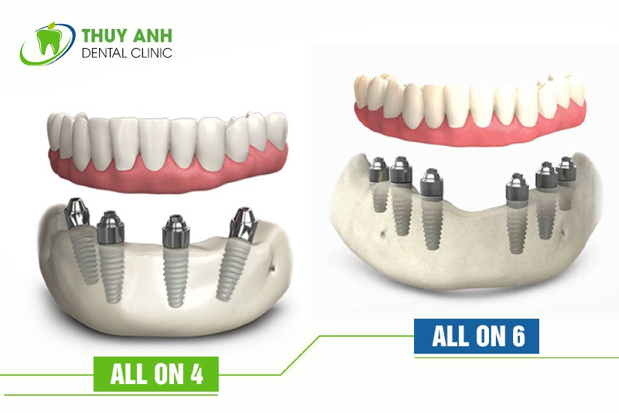 Implant toàn hàm là gì? Có chi phí điều trị là bao nhiêu?