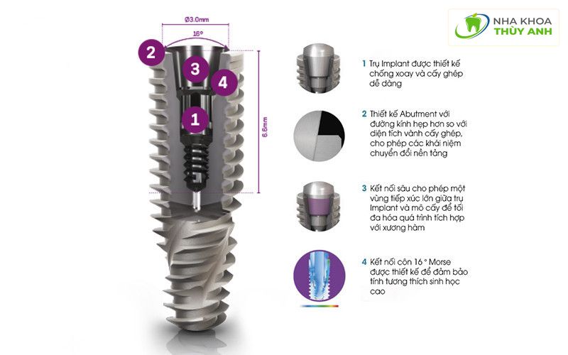 Những thông tin cần biết về trụ implant Neodent